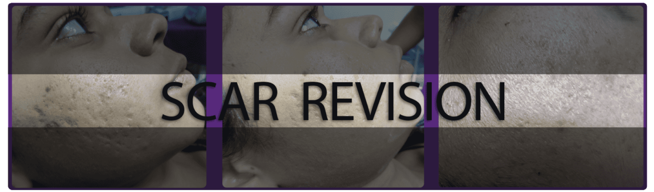 SCAR REVISION | Skin First